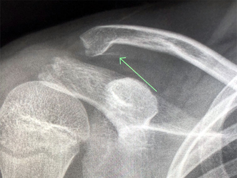 Anterior shoulder pain after falling off a snowboard | AusDoc