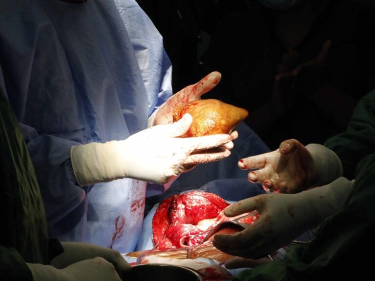 Medical Must-See: Gigantic kidney stone breaks two world records | AusDoc