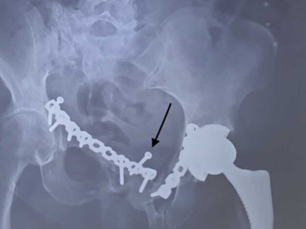 Medical Must-See: Loose screw found in bladder 19 years after pubic ...