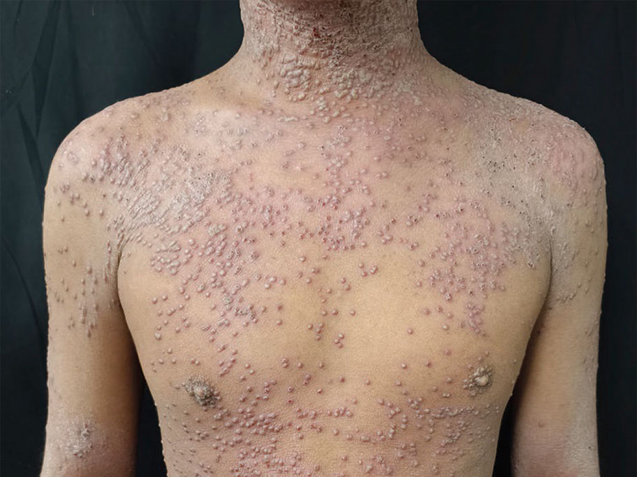 Spot Dx — Untangling the cause of this teen's sudden rash | AusDoc
