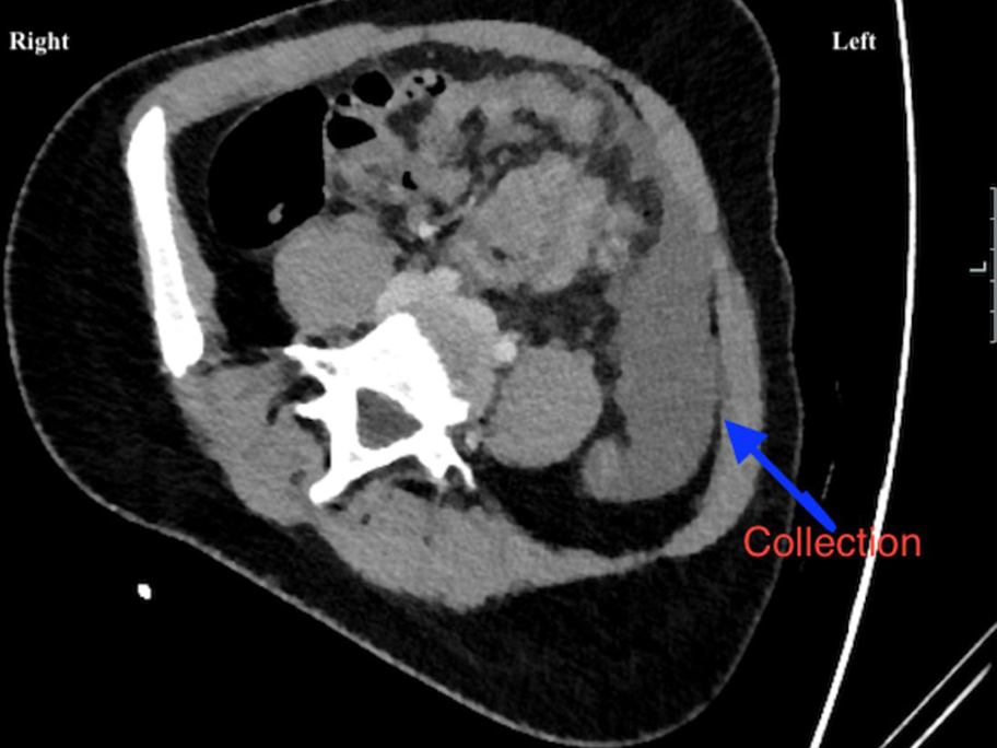 Medical Must-See: A coital corpus luteum rupture | AusDoc