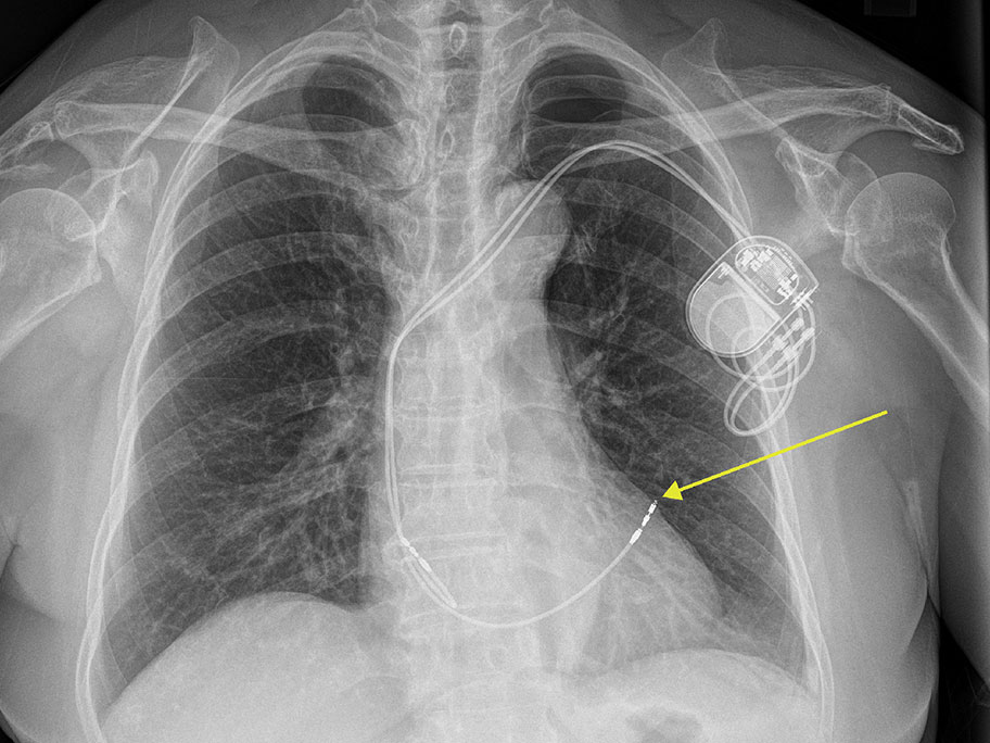 Medical Must-See: Pacemaker lead races into pleural space | AusDoc